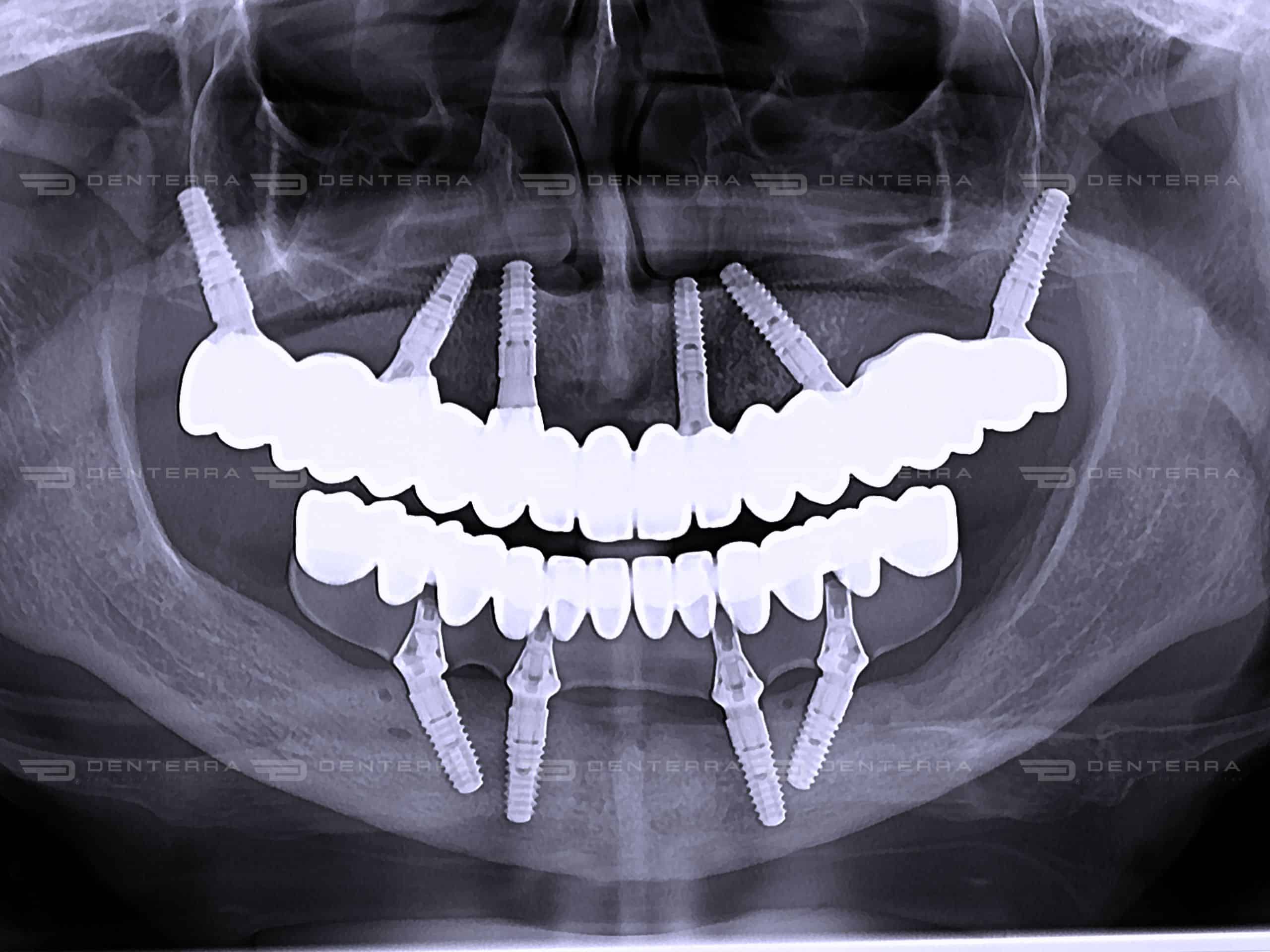 Radiologie dentară - Denterra Clinic